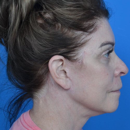 Otoplasty Case 3334 | Weinrach Plastic Surgery: Dr. Jonathan Weinrach