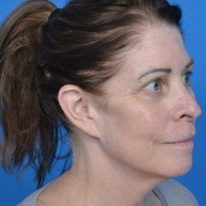 Otoplasty Before And After Pictures | Scottsdale & Phoenix | Weinrach ...