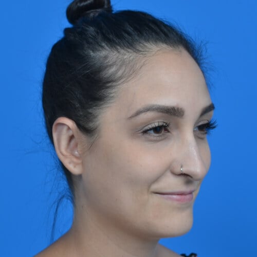 Otoplasty Case 6169 Weinrach Plastic Surgery Dr Jonathan Weinrach