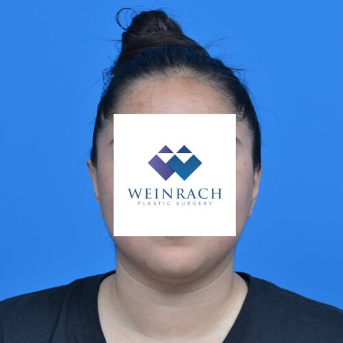 Otoplasty Case 6421 Weinrach Plastic Surgery Dr Jonathan Weinrach