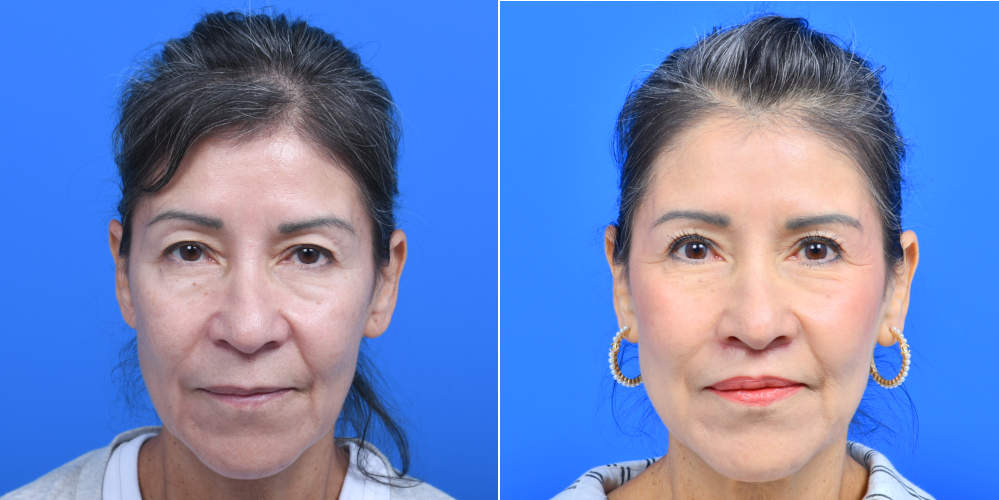 Lip Lift In Scottsdale, AZ